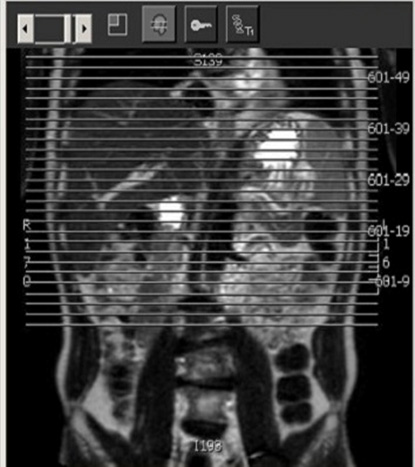 MR Renal Mass W/WO Protocol | OHSU